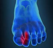 Overlapping Toes – Mass General Brigham Foot & Ankle Store